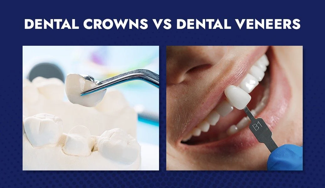 Comparing Dental Veneers vs Dental Crowns | Grand Dental